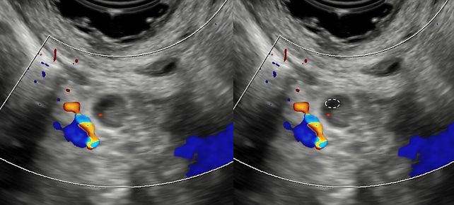 Ultrasound Evaluation of Inguinal and Pelvic Lymph Nodes | Article | GLOWM